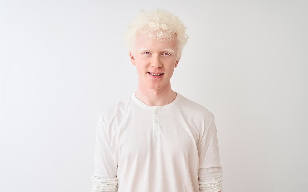 Symptoms, Causes, and Treatment of Albinism | MFine