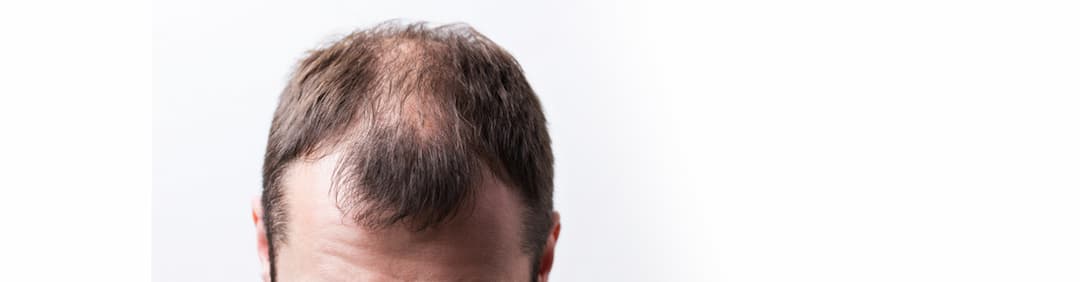 Diffuse Unpatterned Alopecia in Indians: Causes & Treatments
