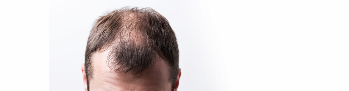 Diffuse Unpatterned Alopecia in Indians: Causes & Treatments