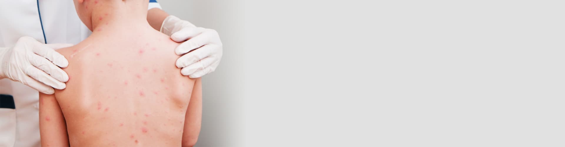 Chicken Pox Scars in Indians: Treatments & Prevention Steps