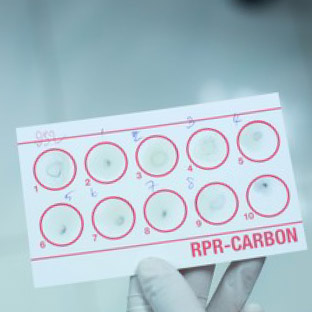 Venereal Disease Research Laboratory (VDRL) Test, 44% OFF